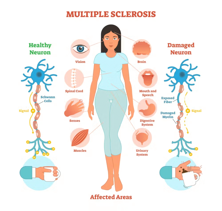 Multiple Sclerosis in India: A Deeper Healing Perspective Beyond Symptoms
