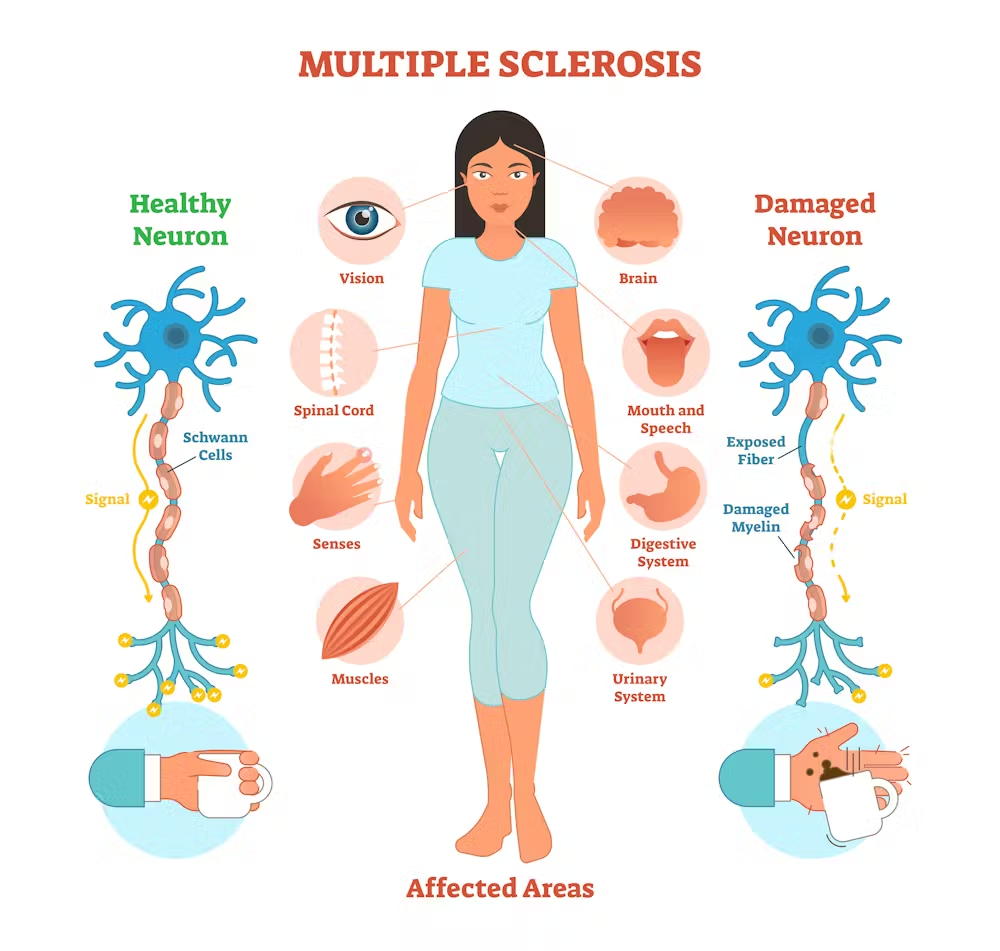 Multiple Sclerosis in India: A Deeper Healing Perspective Beyond Symptoms