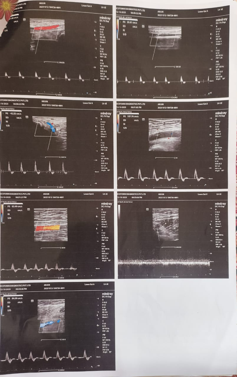 From Chronic DVT to Complete Recovery: A Progressive Journey of Healing ...